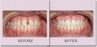 Spaced Teeth - Caribbean Smiles Orthodontics
