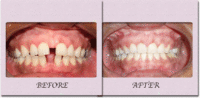 Spaced Teeth - Caribbean Smiles Orthodontics