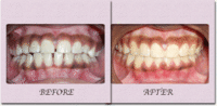 Spaced Teeth - Caribbean Smiles Orthodontics